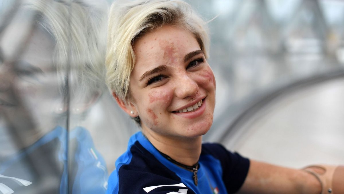 Bebe Vio, la malattia e l'amputazione a 11 anni